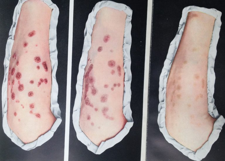 Of Syphilis and Salvarsan: The danger and promise of cure - Dittrick ...